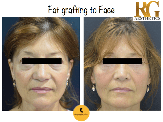 Cosmetic Surgery Before and After Results | Dr. Rajat Gupta - RG Aesthetics