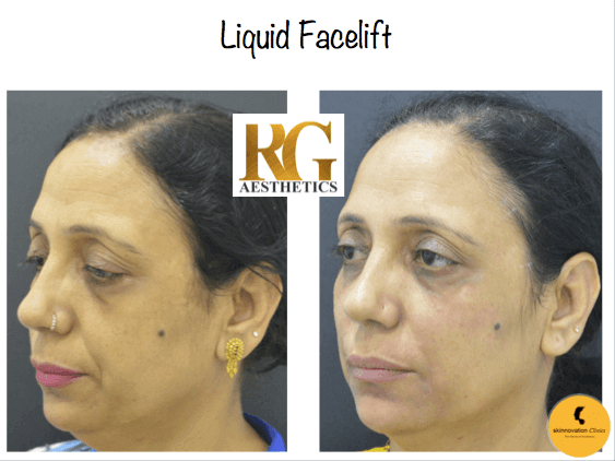 Cosmetic Surgery Before and After Results | Dr. Rajat Gupta - RG Aesthetics