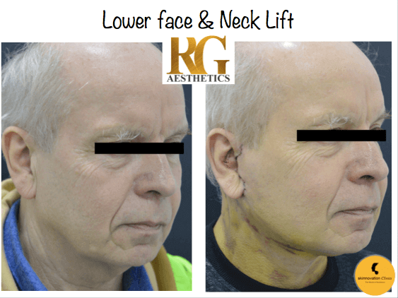 Cosmetic Surgery Before and After Results | Dr. Rajat Gupta - RG Aesthetics