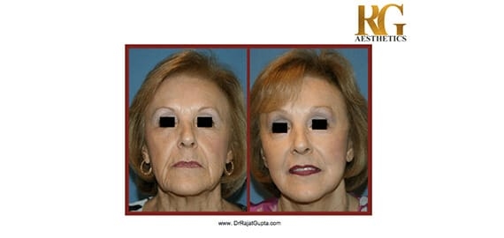 Cosmetic Surgery Before and After Results | Dr. Rajat Gupta - RG Aesthetics