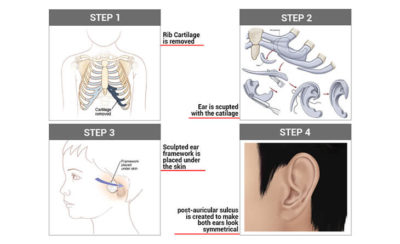 Microtia – Causes, Types & Treatment - Dr Rajat Gupta
