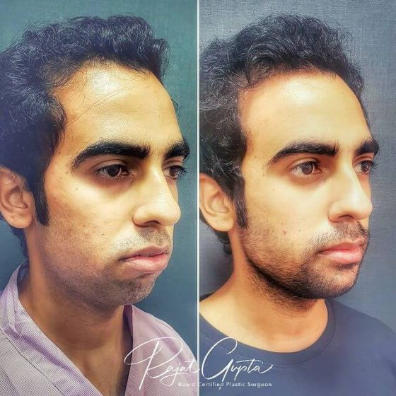 Cosmetic Surgery Before and After Results | Dr. Rajat Gupta - RG Aesthetics