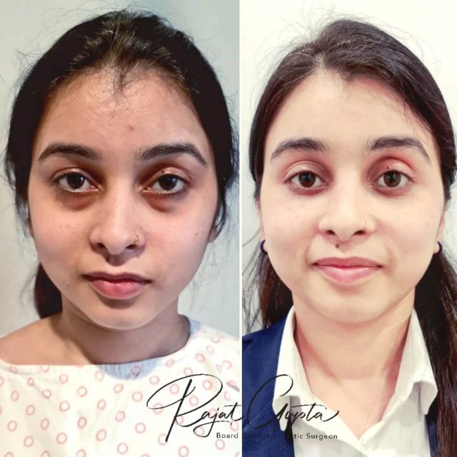 Cosmetic Surgery Before and After Results | Dr. Rajat Gupta - RG Aesthetics