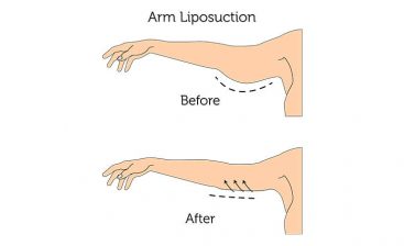 Complete Guide to Brachioplasty/Arm Lift Procedure | Best Plastic Surgeon