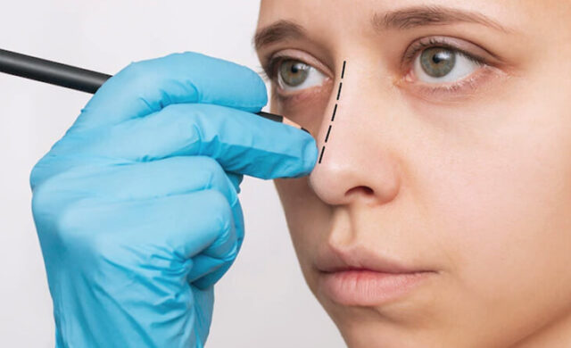 Complete Guide to Rhinoplasty/Nose Job | Dr Rajat Gupta