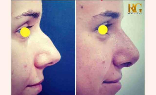 Ultrasonic Nose Job - The Less Invasive Rhinoplasty