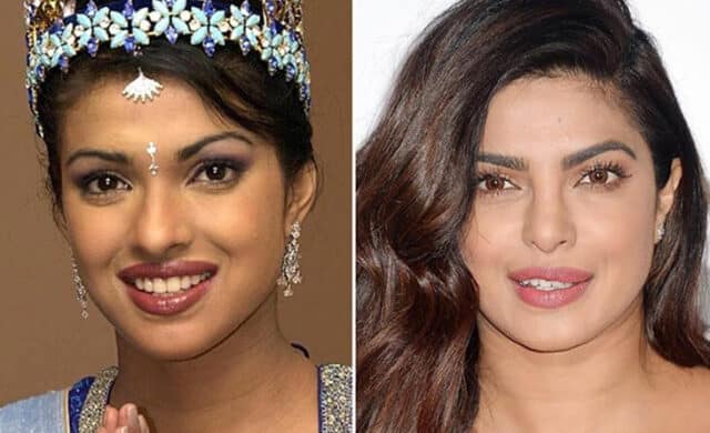 Celebrity Rhinoplasty Surgery in Delhi: Beauty in Bollywood