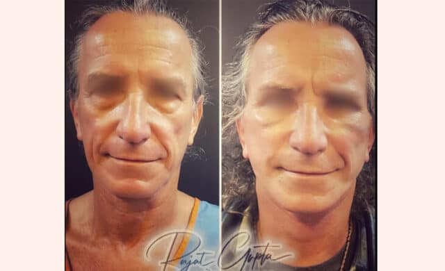Understanding Neck Lift Surgery: Costs and Recovery Times